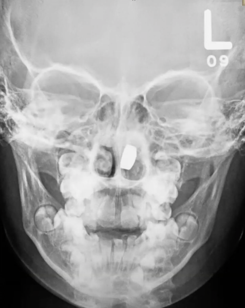 Foreign Bodies in the Ear, Nose and Throat - Pangea Global Health Education